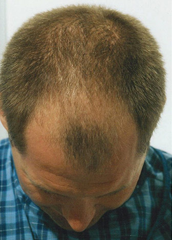 Hair Transplants Perth | Hair Loss Treatments Perth | New Hair Clinic