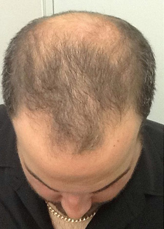 Hair Transplants Perth | Hair Loss Treatments Perth | New Hair Clinic