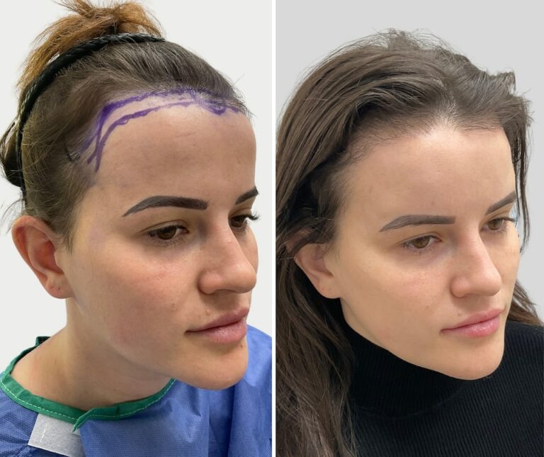 Forehead Reduction Surgery & Hairline Lowering Surgery Perth