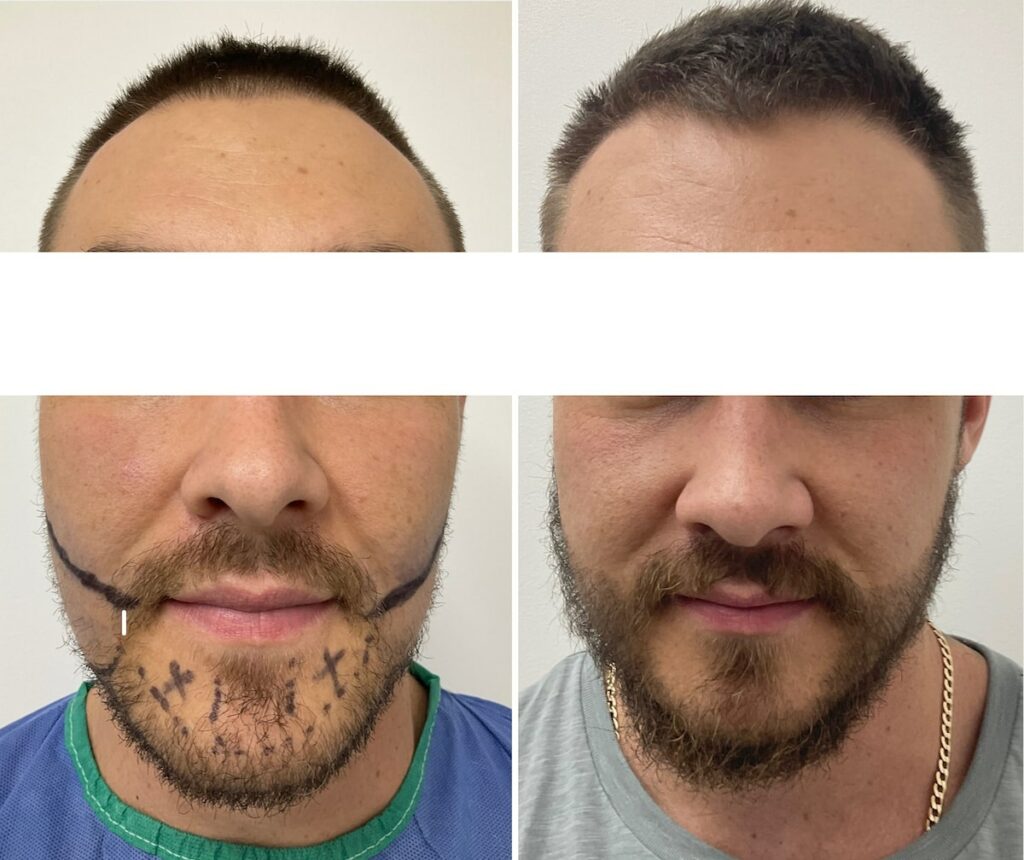 Beard Transplant Perth | Permanent Results